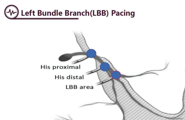 Conduction System Pacing with Dr Bill Petrellis