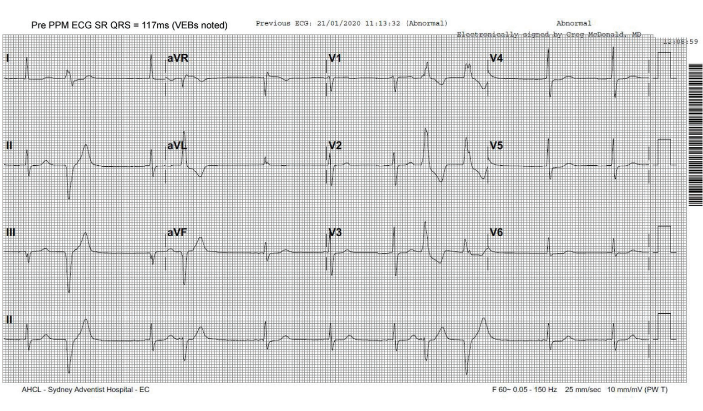 Conduction System Pacing with Dr Bill Petrellis