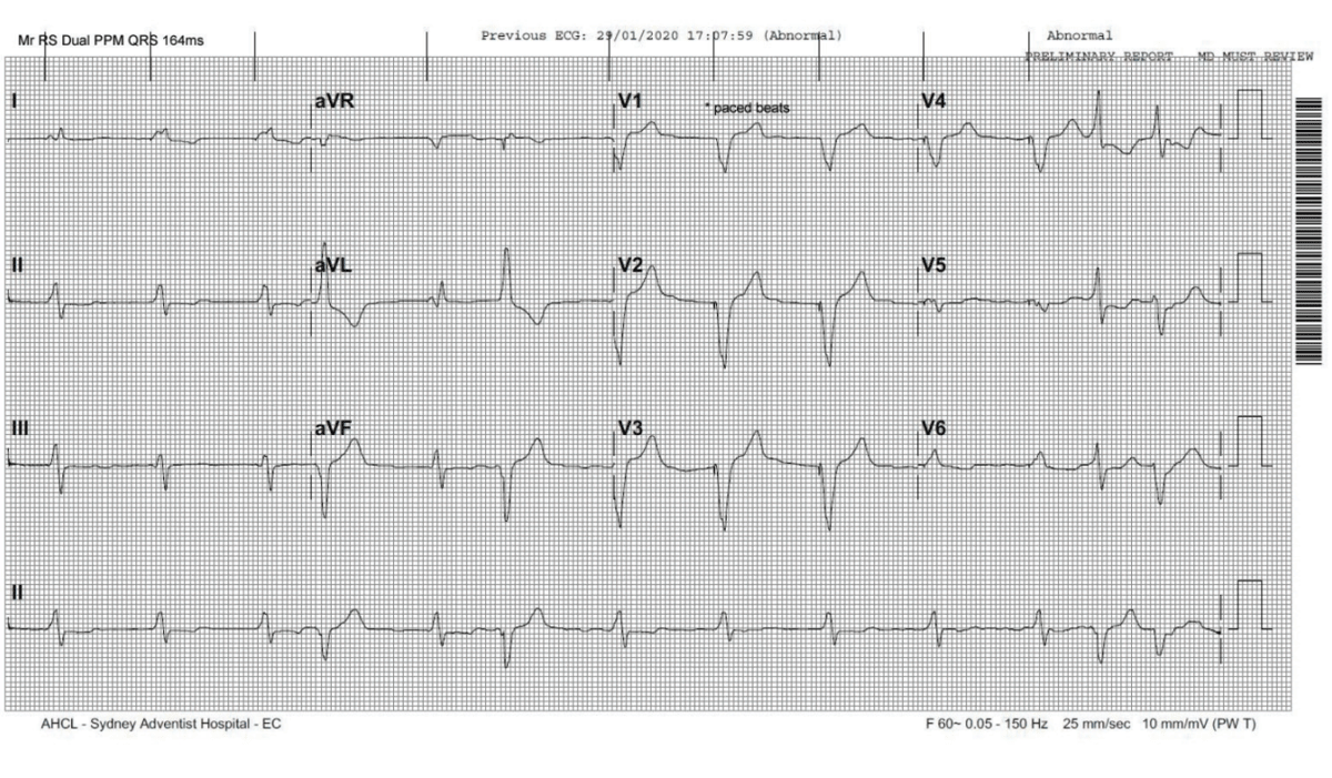 Conduction System Pacing with Dr Bill Petrellis