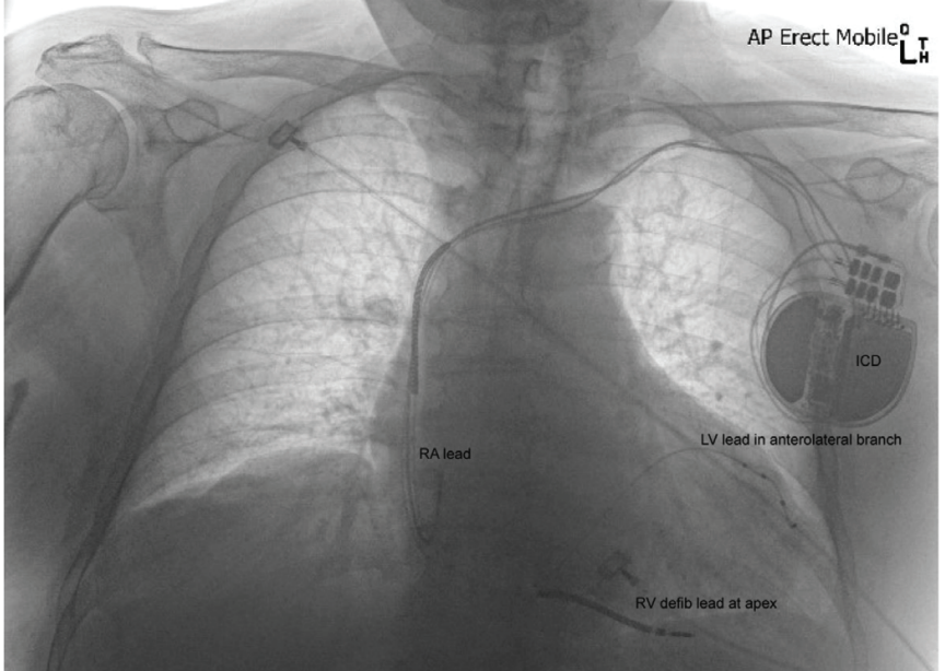Conduction System Pacing with Dr Bill Petrellis